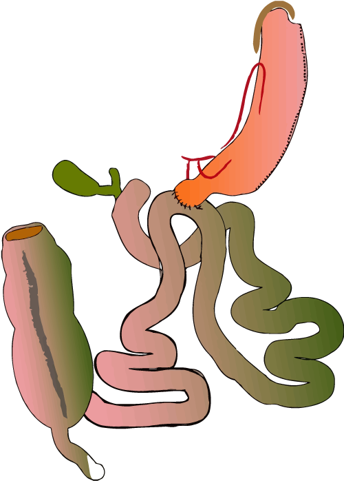 Download Intestinal Pylorus Sparing Surgery - Single Anastomosis ...