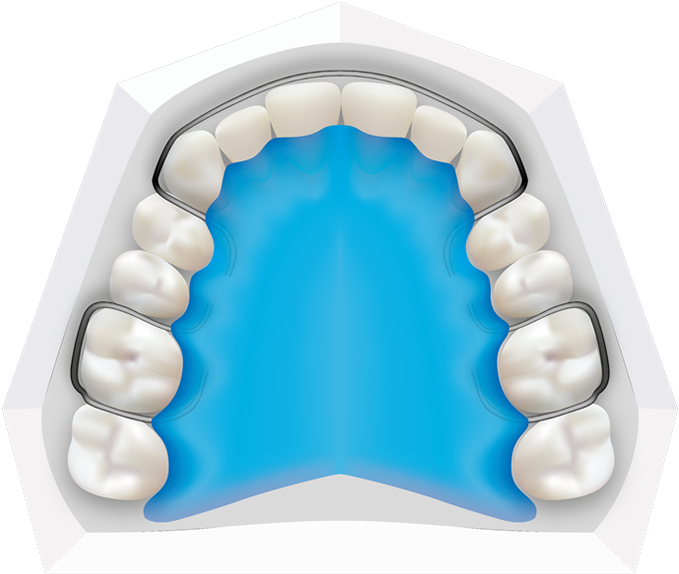 Download Removable Retainers At Toothbeary - Illustration - ClipartKey