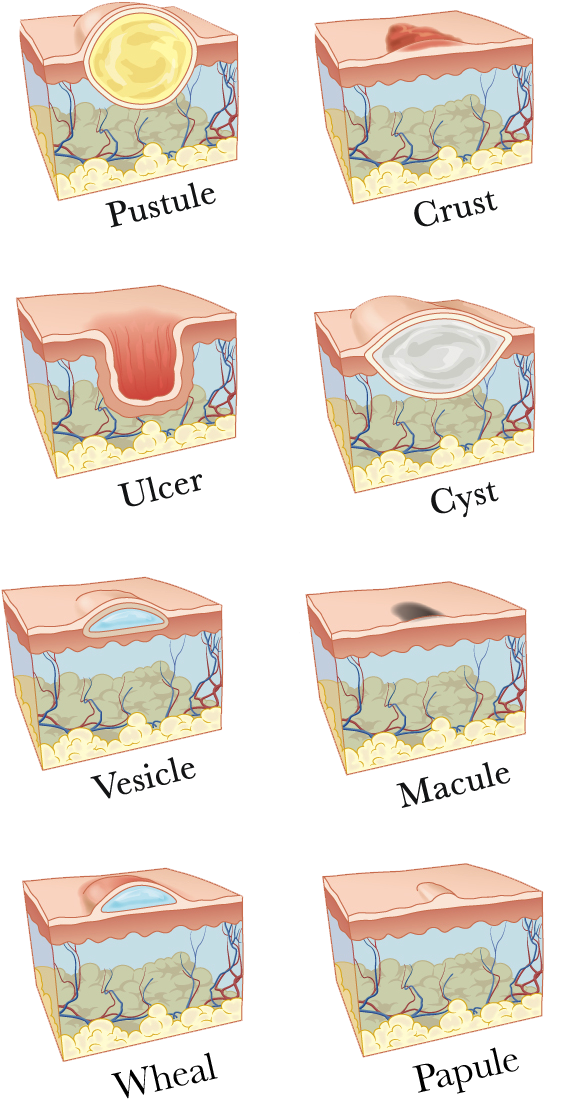 Download Types Of Skin Lesions - ClipartKey