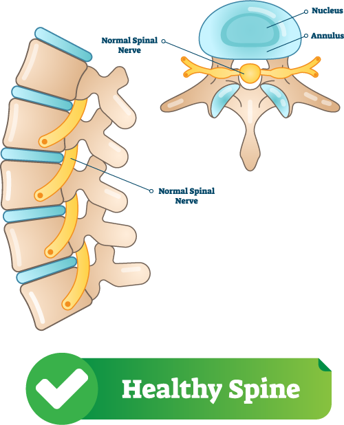 Download Healthy Spine - Spinal Stenosis - ClipartKey
