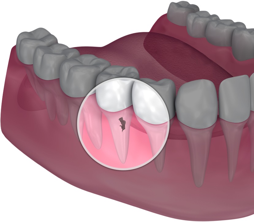 Download Crown Lengthening - ClipartKey