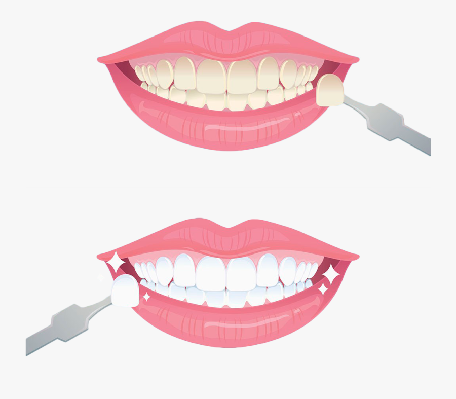 Tooth Whitening Euclidean Vector - Teeth Whitening Background , Free ...