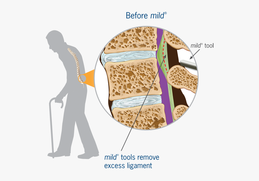 Before Mild - Spinal Stenosis Mild Procedure , Free Transparent Clipart ...