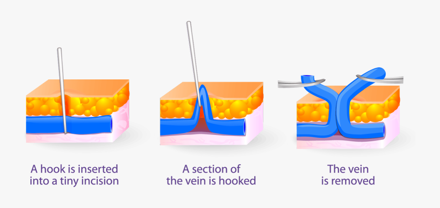 Phlebectomy Treatment - Ambulatory Phlebectomy , Free Transparent ...