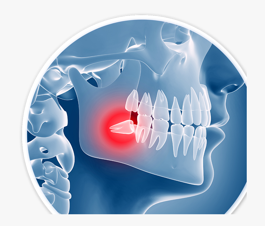 Illustration Of Jaw In Blue With Wisdom Tooth In Red - Wisdom Teeth ...