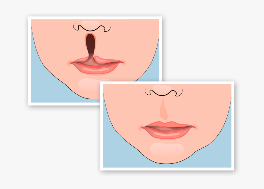 Before And After Illustration Of Cleft Lip Surgery - Lips With Cleft ...