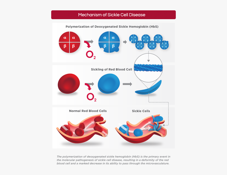 Sickle Cell Pathophysiology , Free Transparent Clipart - ClipartKey