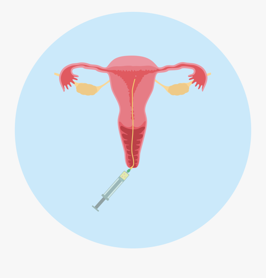 Ivf Process Embryo Transfer , Free Transparent Clipart - ClipartKey
