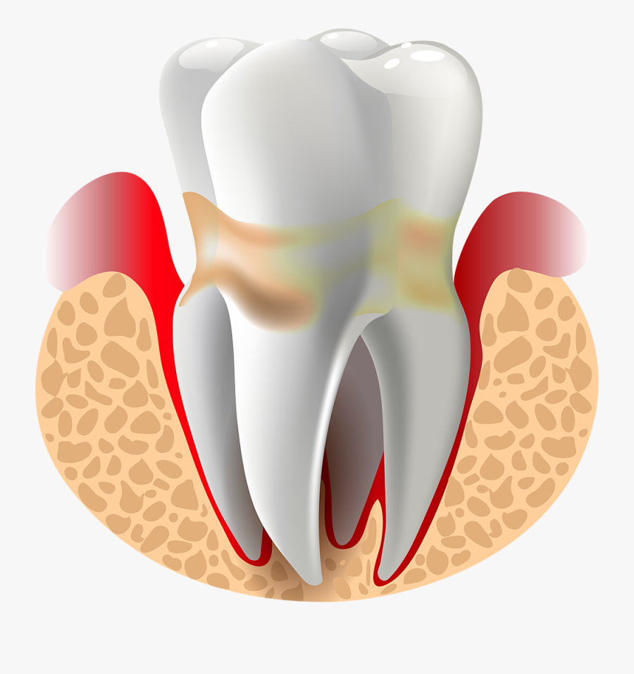 Gum Disease Illustration Falls Church, Va - Normal Tooth Vs ...