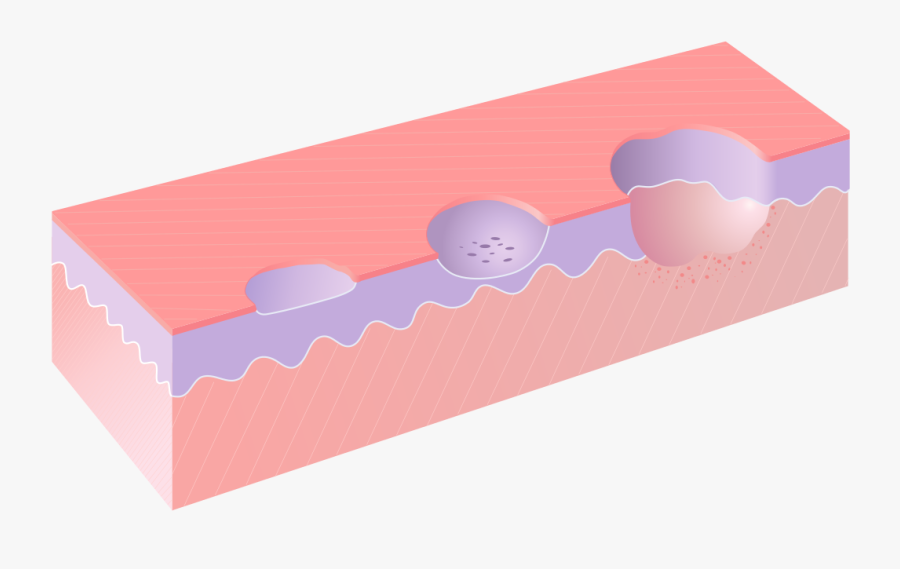 Excoriation Erosion , Free Transparent Clipart - ClipartKey