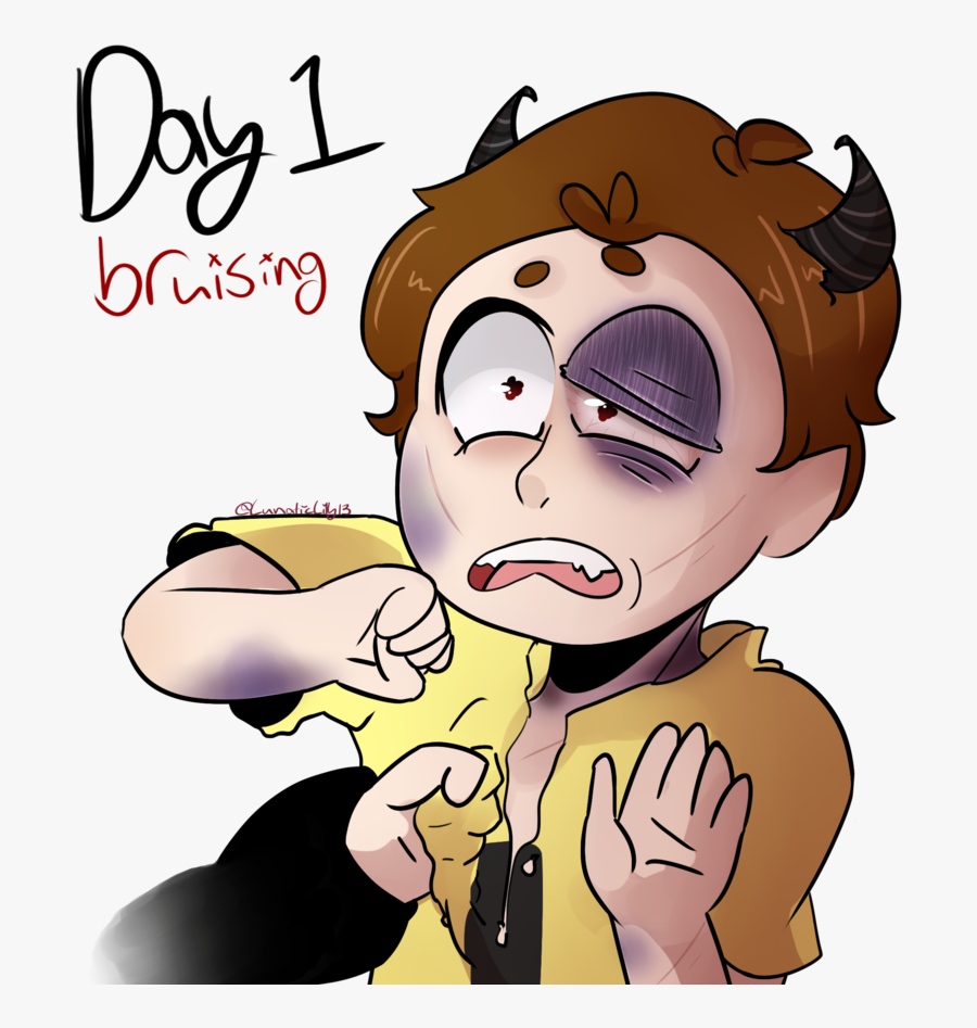 Collection Of Free Bruising - Bruise In Clip Art , Free Transparent ...