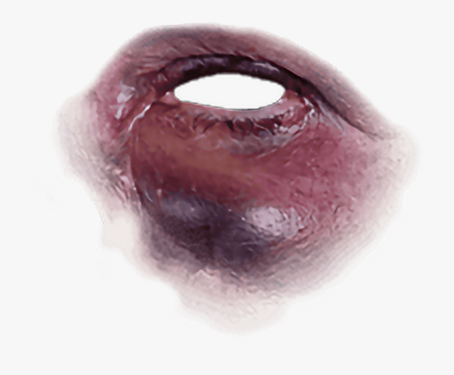 Black Eye - Bruise Black Eye Transparent , Free Transparent Clipart ...