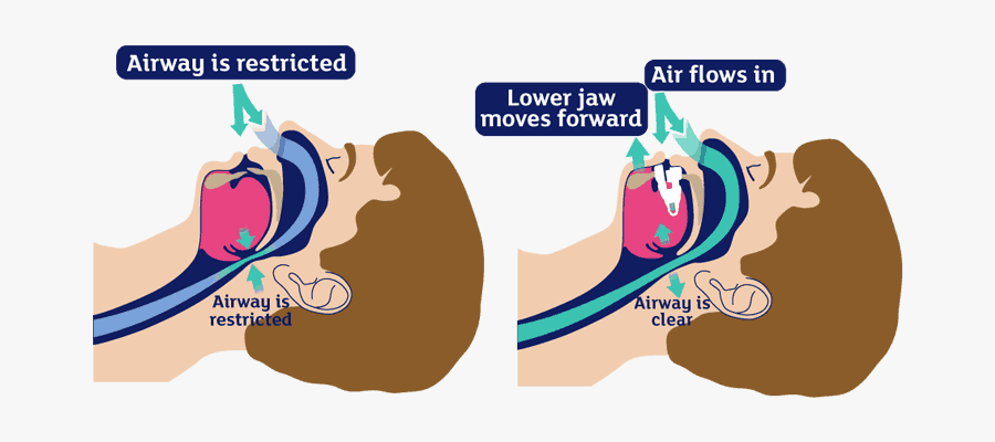 Loud Snoring And Obstructive Sleep Apnoea - Sleep Apnea Graphic , Free ...