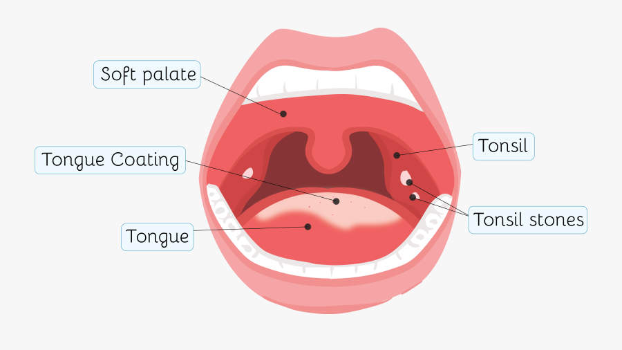 Clip Art Tonsillitis And Tonsil Stones - Immune System Tonsils , Free ...