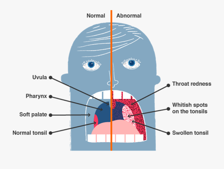 Strep Throat Illustration , Free Transparent Clipart - ClipartKey