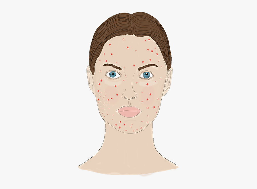 Acne Png Page - Illustration , Free Transparent Clipart - ClipartKey