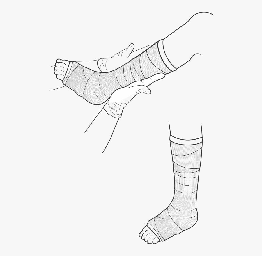 Leg Cast - Drawings Of Leg Casts , Free Transparent Clipart - ClipartKey