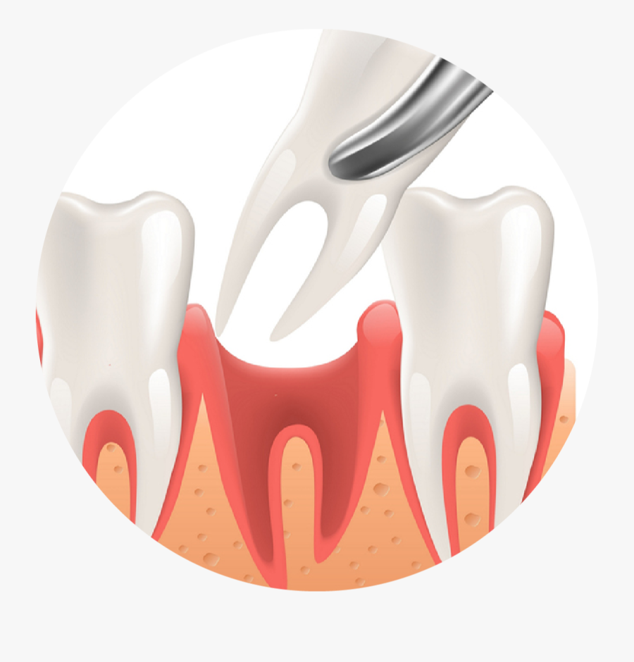 Oral Surgery Extractions , Free Transparent Clipart - ClipartKey