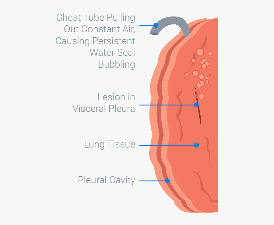 Chest Tube Air Bubble , Free Transparent Clipart - ClipartKey