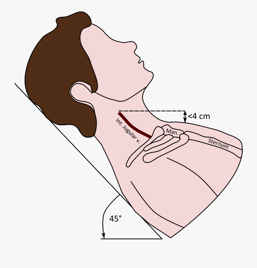 Jugular Venous Pressure Jvp - Sternal Angle Jugular Venous Pressure ...