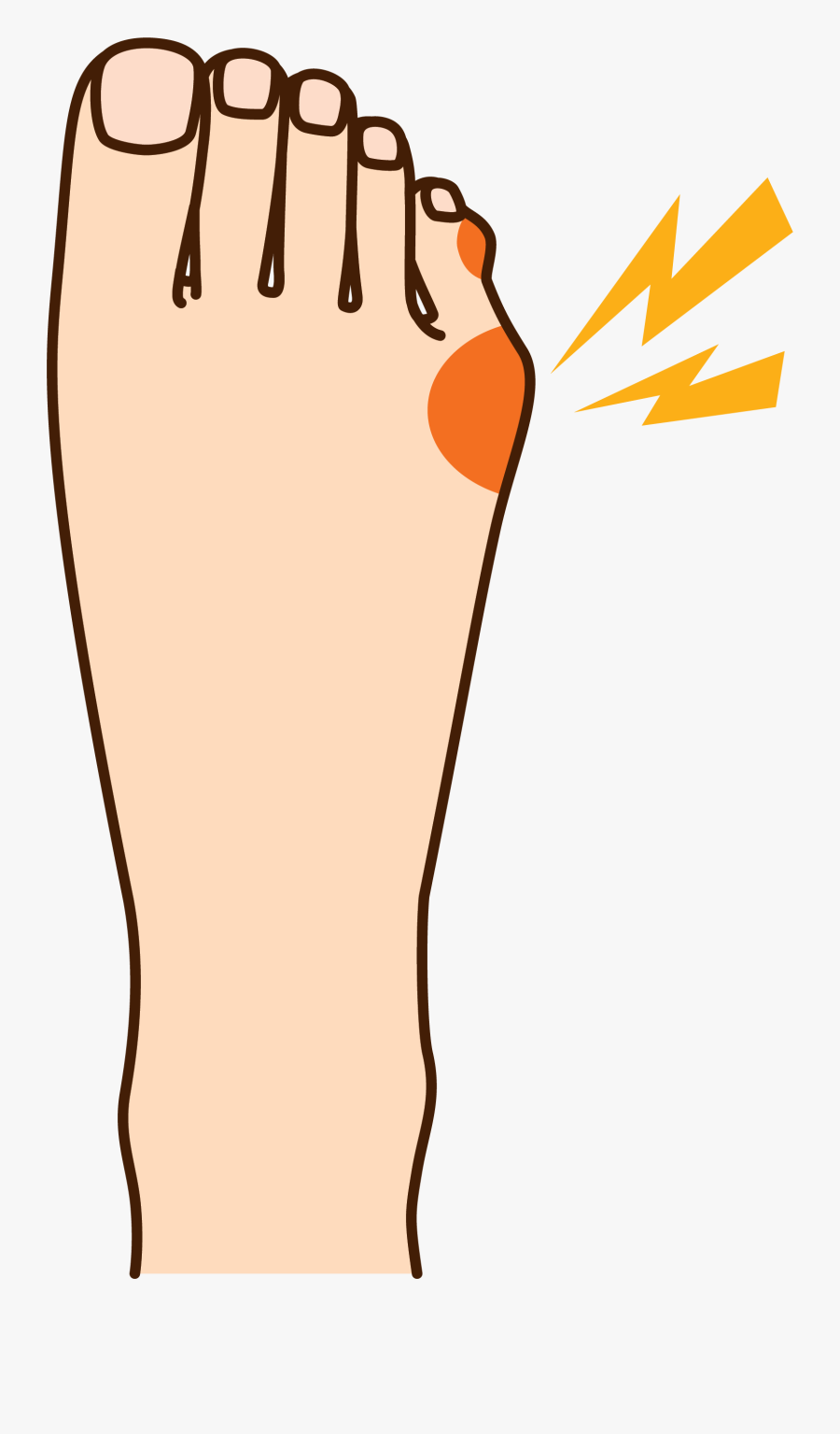 Nail Clipart Big Toe - Tailor's Bunion On Pinky Toe , Free Transparent ...